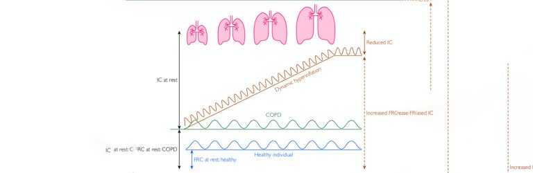 What is Hyperinflated Lungs and How to Manage it?