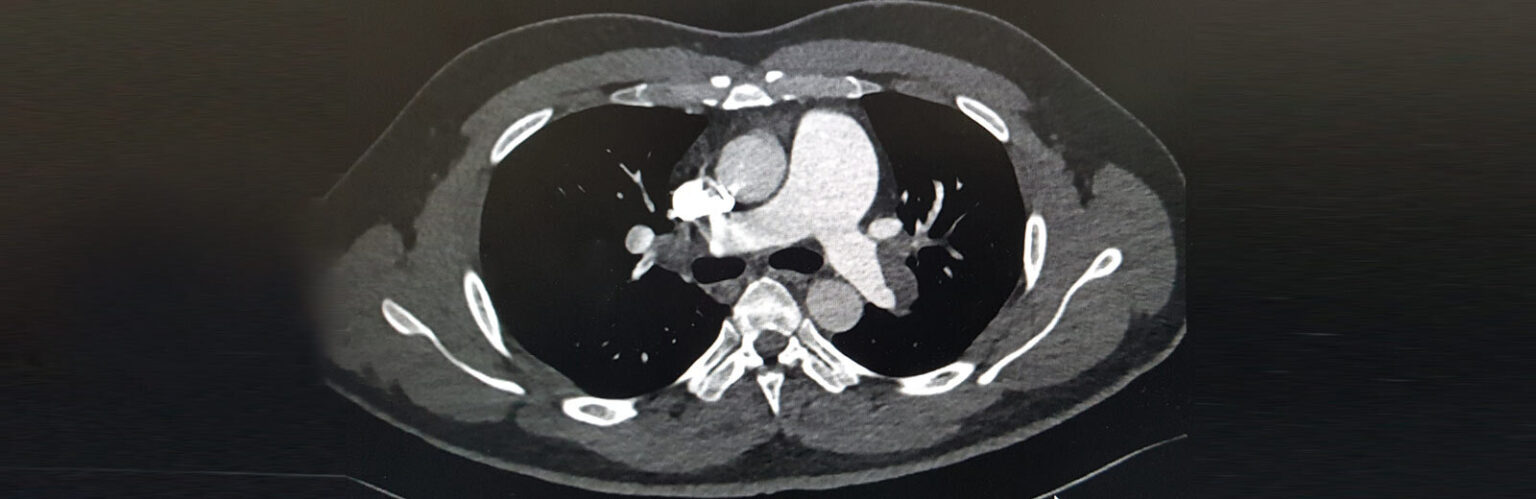 Everything You Need to Know About Saddle Pulmonary Embolism