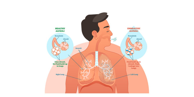 Pulmonary Vascular Congestion - An Overview